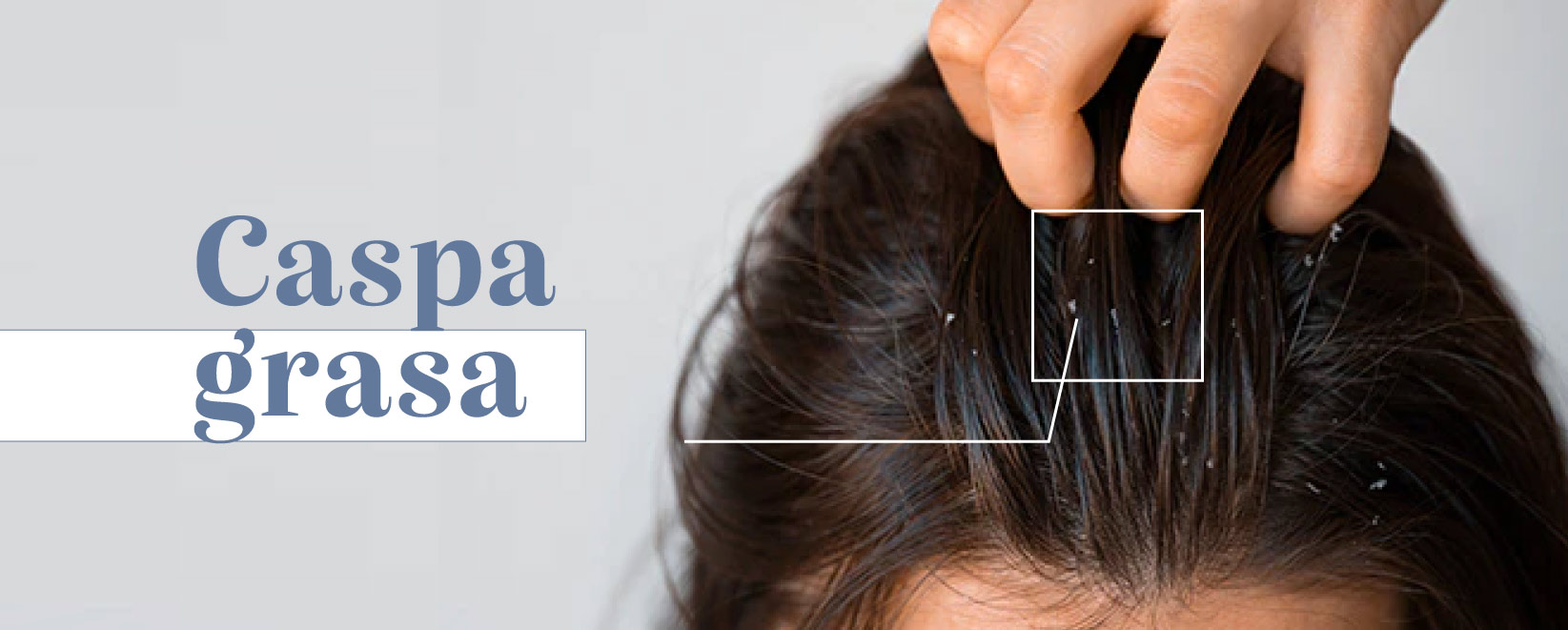 Tipos de caspa: ¿Cómo identificarlas y qué hacer con cada una? - Blog ...
