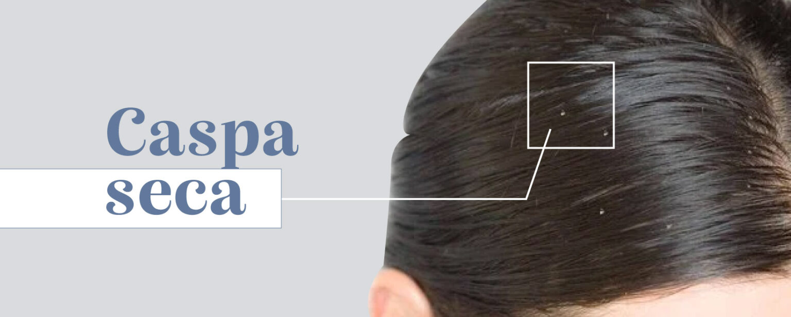 Tipos de caspa: ¿Cómo identificarlas y qué hacer con cada una? - Blog ...