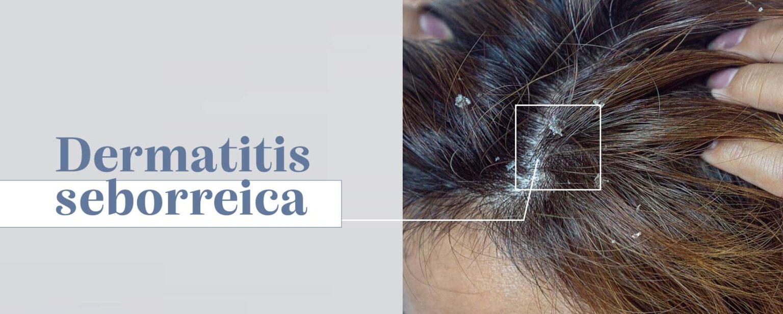 Tipos de caspa: ¿Cómo identificarlas y qué hacer con cada una? - Blog ...
